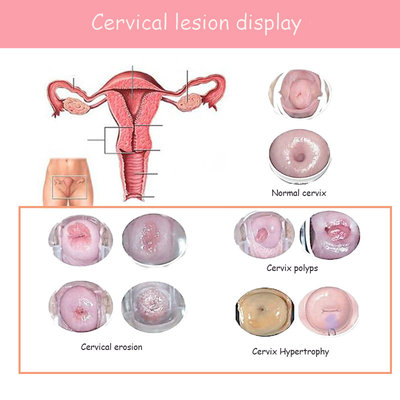 Smart design cold laser therapy vaginitis gynaecology home remedy no side-effect supplier