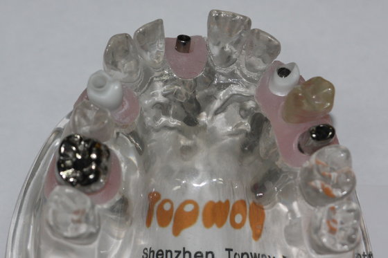 Titanium Dental Implant Abutment And Crown Individually Designed For Dental Clinic
