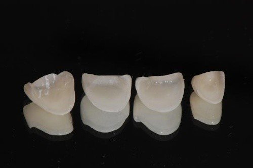 Natural Looking Porcelain Dental Veneers , Ceramic Veneers For Your Teeth