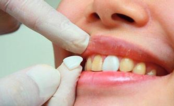 0.3MM Whitening Composite Veneers For Replace Unhealthy Teeth