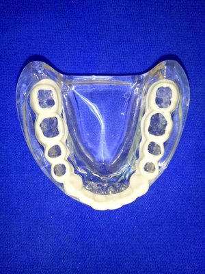 Comforatable Snap on Snap With Germany Dentaurum Resin Material