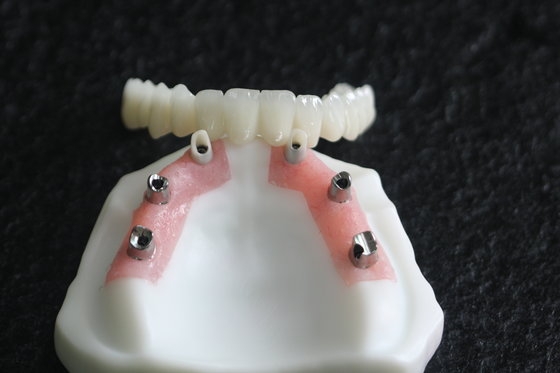 Cemented / Screwed Dental Implant Crown , Full Mouth Tooth Implant Bridge