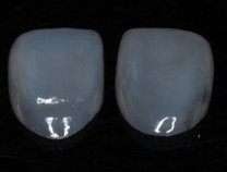 Cosmetic Porcelain Dental Veneers , Ceramic Veneers Teeth Natural Appearance