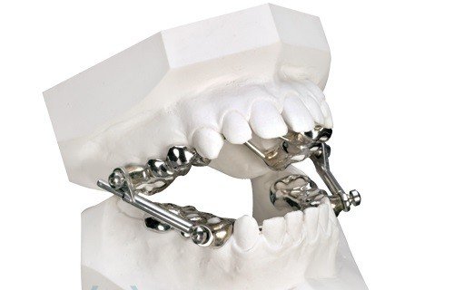Halfopen Activator Dental Orthodontic Appliances Closing Open Bite
