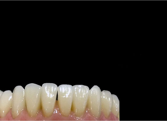Beautifully Fine BIO HPP Crowns , Dental Bridge Crown Gracefully Delicate Currency
