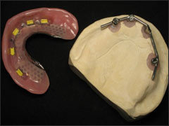 High Retention Implant Support Dentures , Titanium Hybrid Implant Bar Attachment