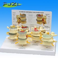 China Model of pathological 4-stage vertebral(Disk Degeneration 4 Stages) supplier