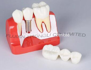 China Dental Implant 3 Unit Bridge 3 Crowns Set of 6 Parts Model 4 Times Life-Size Reconstruction supplier