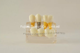 China Dental Implant 3 Unit Bridge 3 Crowns Set of 6 Parts Model 4 Times Life-Size Reconstruction supplier