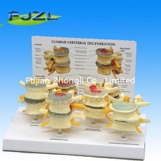 China 4-stage pathological vertebrae lifetime flexible human spine, medical teaching model vertebral supplier