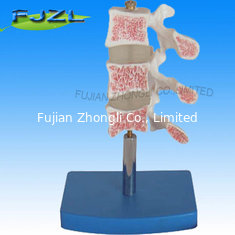 China Cutaway Osteoporosis ( (3 Vertebrae) supplier