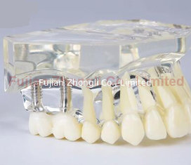 China Transparent base station on both sides of the implant nail bridge demonstration supplier