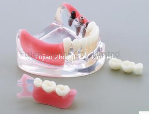China Dental 3 Implant 2 Unit Bridge of 3 Parts supplier