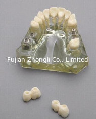 China Dental 4 Implant 2 units bridge of 3 parts supplier