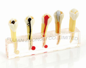 China Dental 5 stage forendodontic treatment model supplier