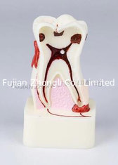 China 4 times dental disease comprehensive disease model dental caries dental calculus pulp stone occlusal wear pathological supplier