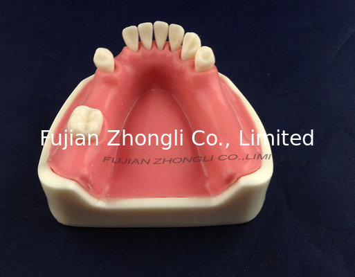 dental implant model with soft gingiva for practice supplier
