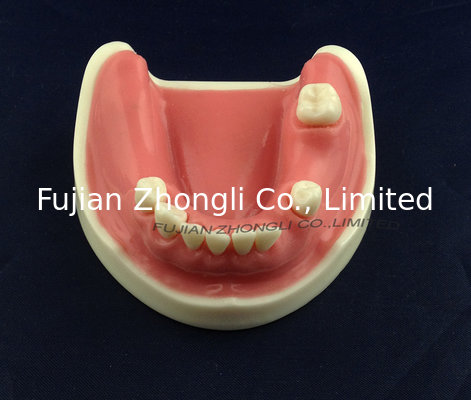 dental implant model with soft gingiva for practice supplier