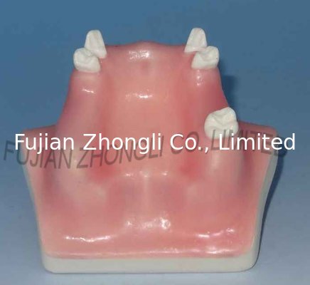 Sinus Lift Maxillary Model Sinus Grafting Operative Techniques supplier