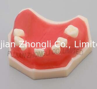 sinus lift dental implant from China supplier