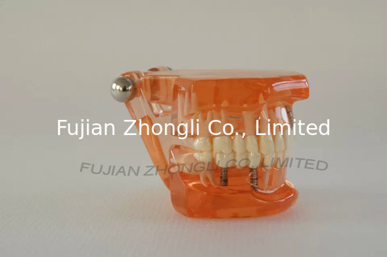 Dentist Dental Implant Disease Teeth Model with Restoration &amp; Bridge Tooth Study supplier