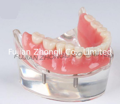 dental 4 impants hybrid denture combination lower arch model supplier
