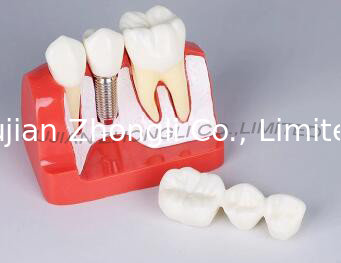 Dental Implant 3 Unit Bridge 3 Crowns Set of 6 Parts Model 4 Times Life-Size Reconstruction supplier