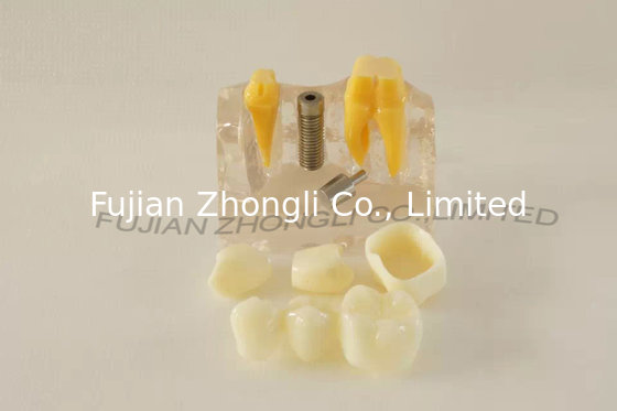 Dental Implant 3 Unit Bridge 3 Crowns Set of 6 Parts Model 4 Times Life-Size Reconstruction supplier