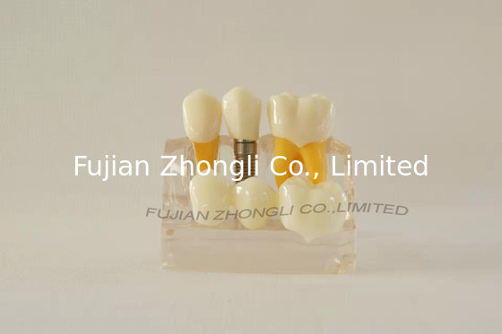 Dental Implant 3 Unit Bridge 3 Crowns Set of 6 Parts Model 4 Times Life-Size Reconstruction supplier