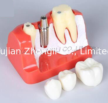 Dental Implants 3 Units Bridge 2 Crowns Reconstruction supplier