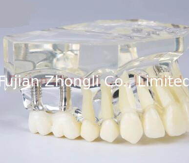 Transparent base station on both sides of the implant nail bridge demonstration supplier