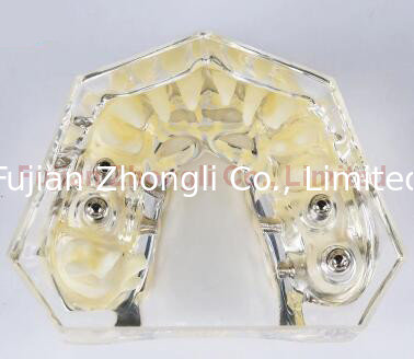 Transparent base station on both sides of the implant nail bridge demonstration supplier