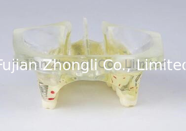 transparent sinus lift  implant model  Dental Model of osteoporosis dental materials supplier