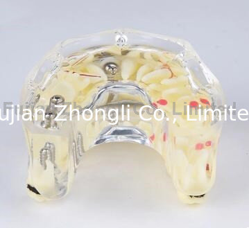 dental caries dental bridge dental teaching communication oral implant nail demonstration model supplier