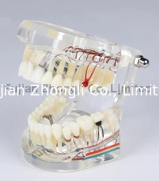Transparent prothetic with implant model dental nerve demonstrate model doctor-patient communication model supplier