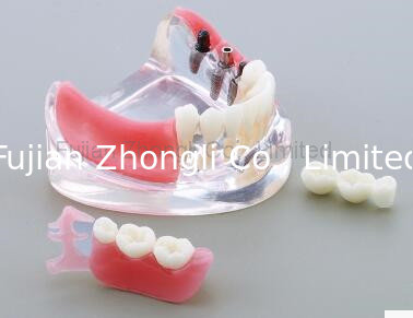 Dental 3 Implant 2 Unit Bridge of 3 Parts supplier