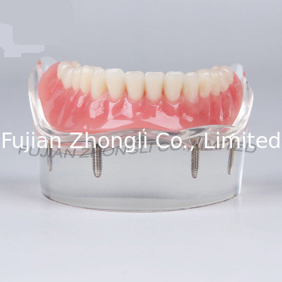 Dental 4 Implants Locator Lower Arch Model supplier