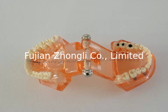 Dental Upper &amp; Lower Jaws Advanced Work Restoration Combination 3 Implant 2 Bridges 7 Crowns Veneer In Lay Kit of 9 Part supplier