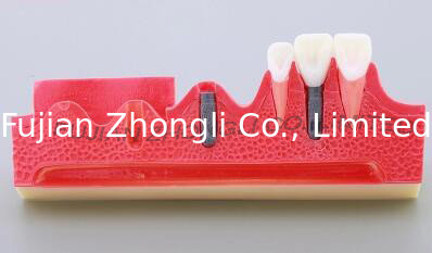 Dental implanting step demonstration red strip planting demonstration model implanting nail display crown configuration supplier