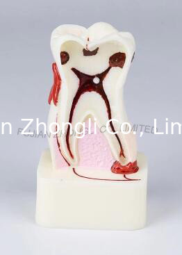 4 times dental disease comprehensive disease model dental caries dental calculus pulp stone occlusal wear pathological supplier