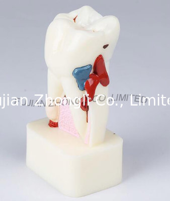 4 times dental disease comprehensive disease model dental caries dental calculus pulp stone occlusal wear pathological supplier