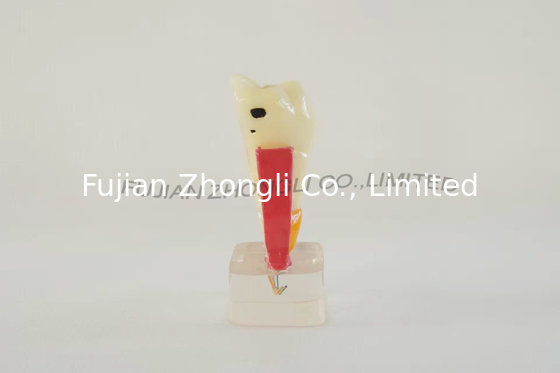 dental 4 times periodontal disease model with nerve model supplier
