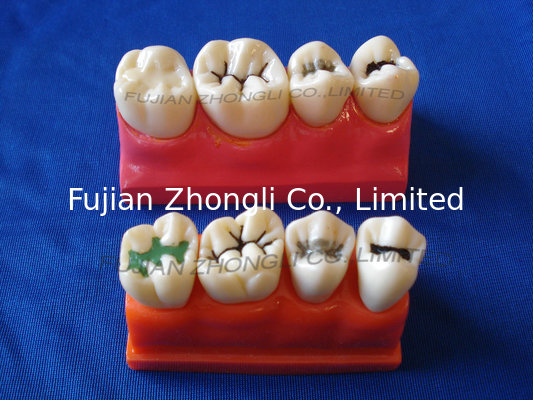 Dental Four times the pit and fissure model supplier
