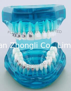 Dental Correction Model Bracket Contrast Model Metal Brackets Ceramic Brackets supplier