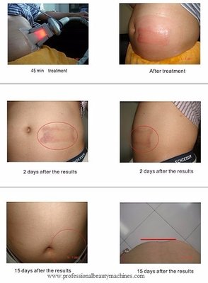 Cryolipolysis Fat Freeze Slimming Machine , Stationary Body Shaping Machine