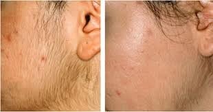 ipl hair removal machine high quality ipl laser hair removal machine