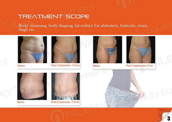 HIFU slimming machine vacuum radio frequency infrared slimming machine