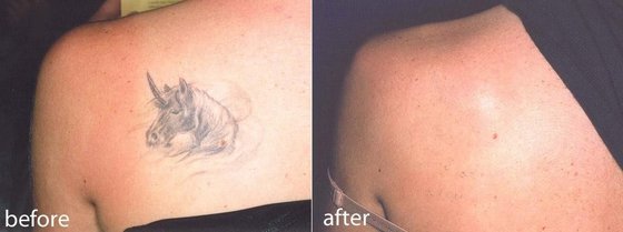 tattoo removal laser machine portable nd yag laser hair removal