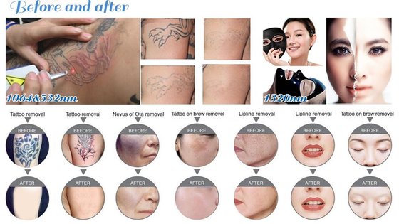 Long Pulse Portable ND Yag Laser Machine / Laser Tattoo Removal Machine