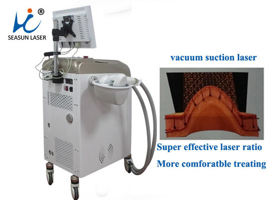 Vacuum Laser Therapy Lightsheer Duet Diode Hair Removal Permanent For Face
